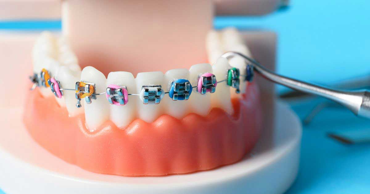 What are the Best Braces Colors? Braces Color Wheel