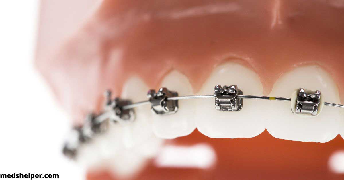 Is it Good to get Black Braces Colors? - Meds Helper